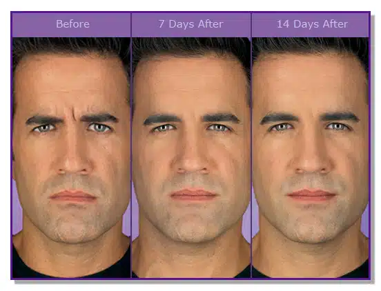 Botox Before And After Men