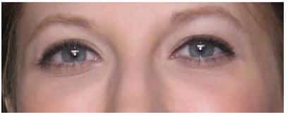 Treat Deep Tear Trough & Bags Under Eyes | Boston