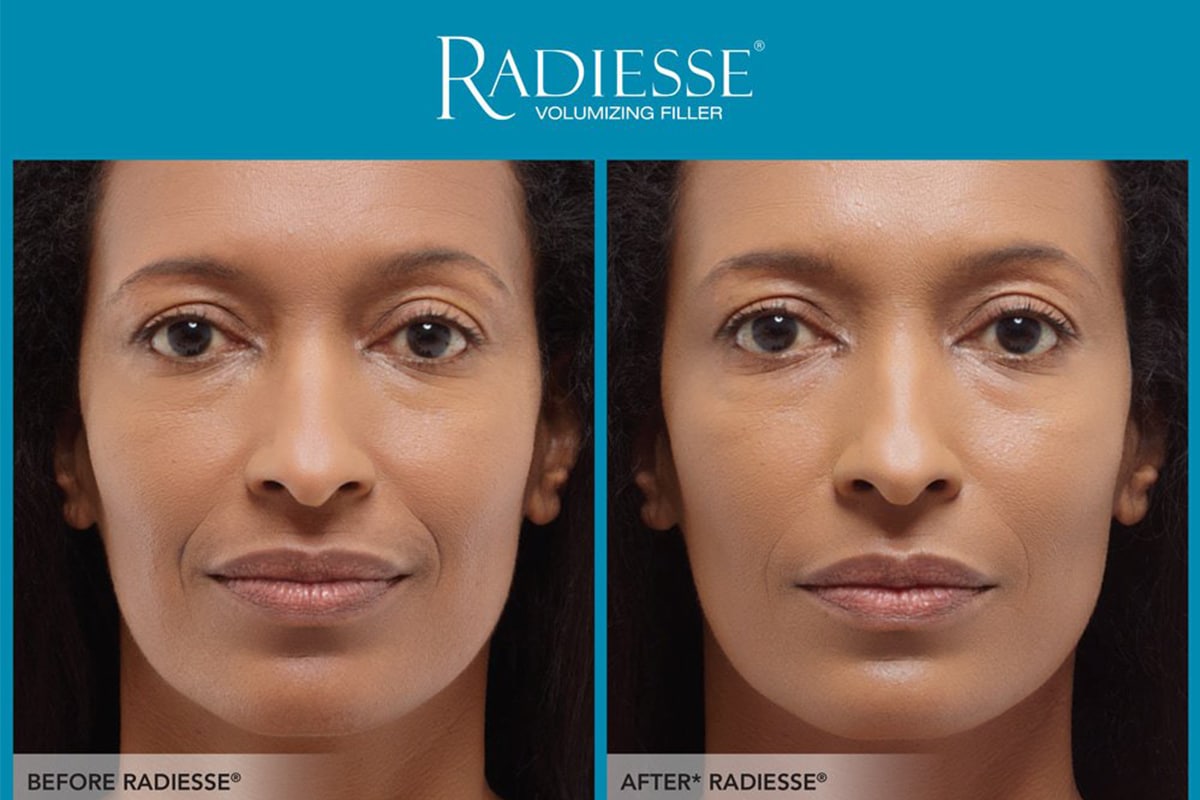 Radiesse Boston | Smooth Wrinkles and Lines | Dr. Sean Doherty