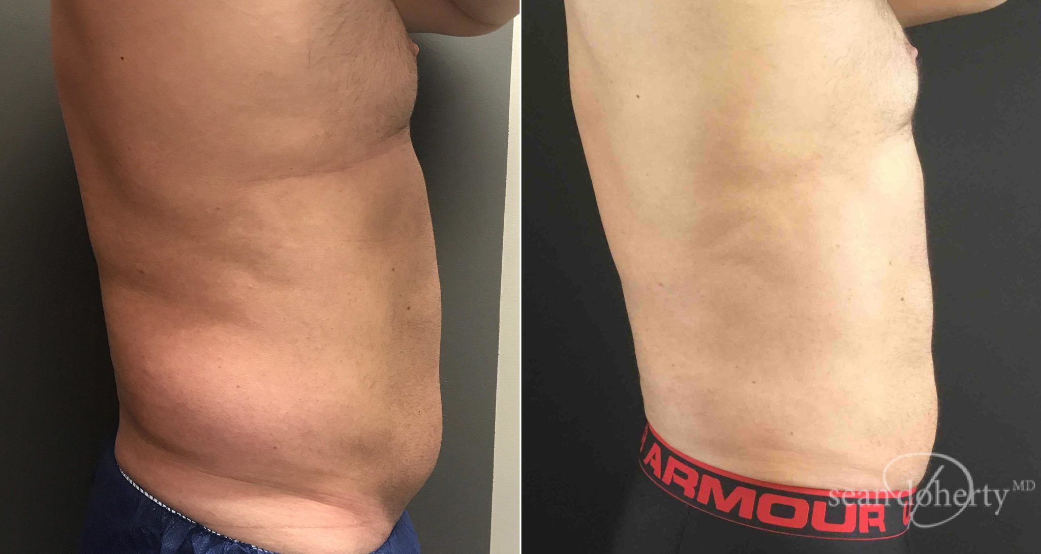 Local Anesthesia Liposuction | Boston