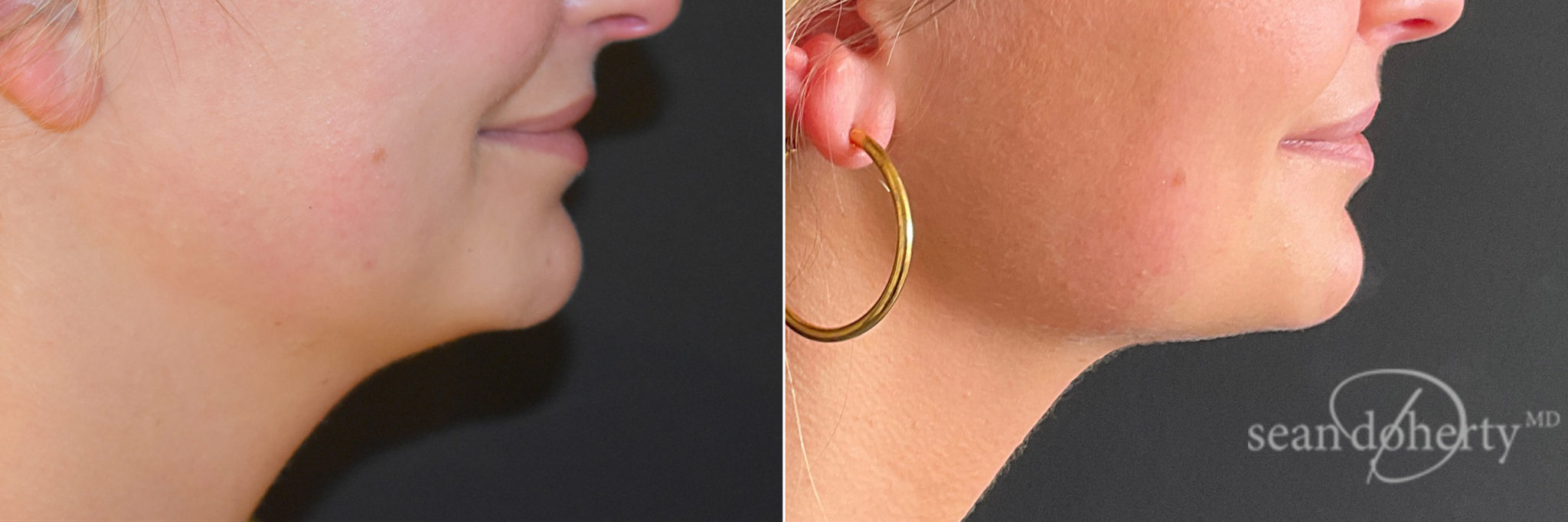 Local Anesthesia Liposuction | Boston